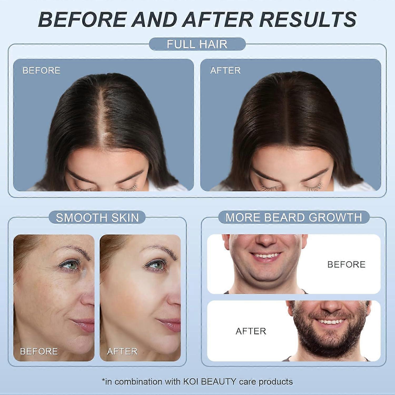 140 Titanium Microneedling Stamp - Adjustable 0-3mm for Hair Growth ...