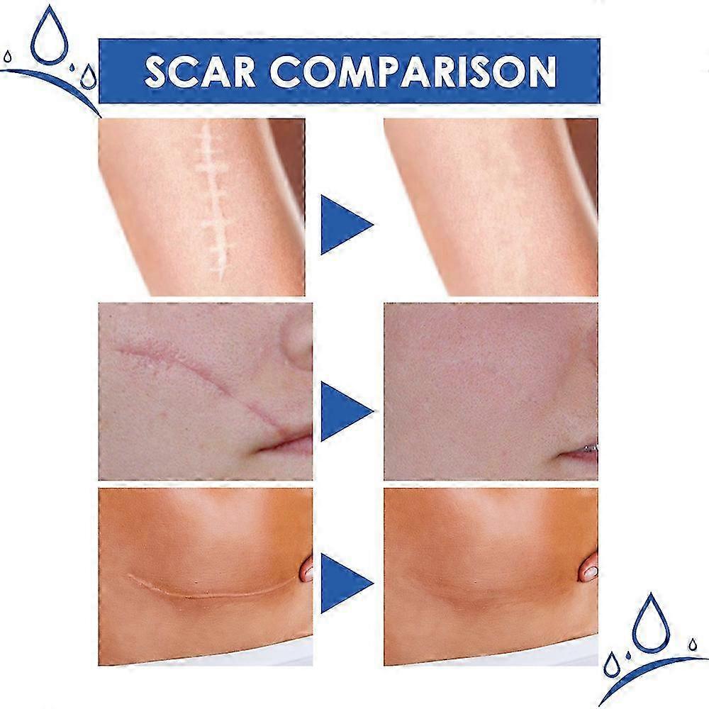 1-3X Acnes Scars Removal Cream Strong Effectiveness Non-irritating ...