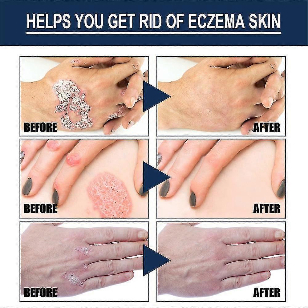 Psoriasis Treatment Spray Hand Foot Scalp Anti-itch Desquamation Tinea ...