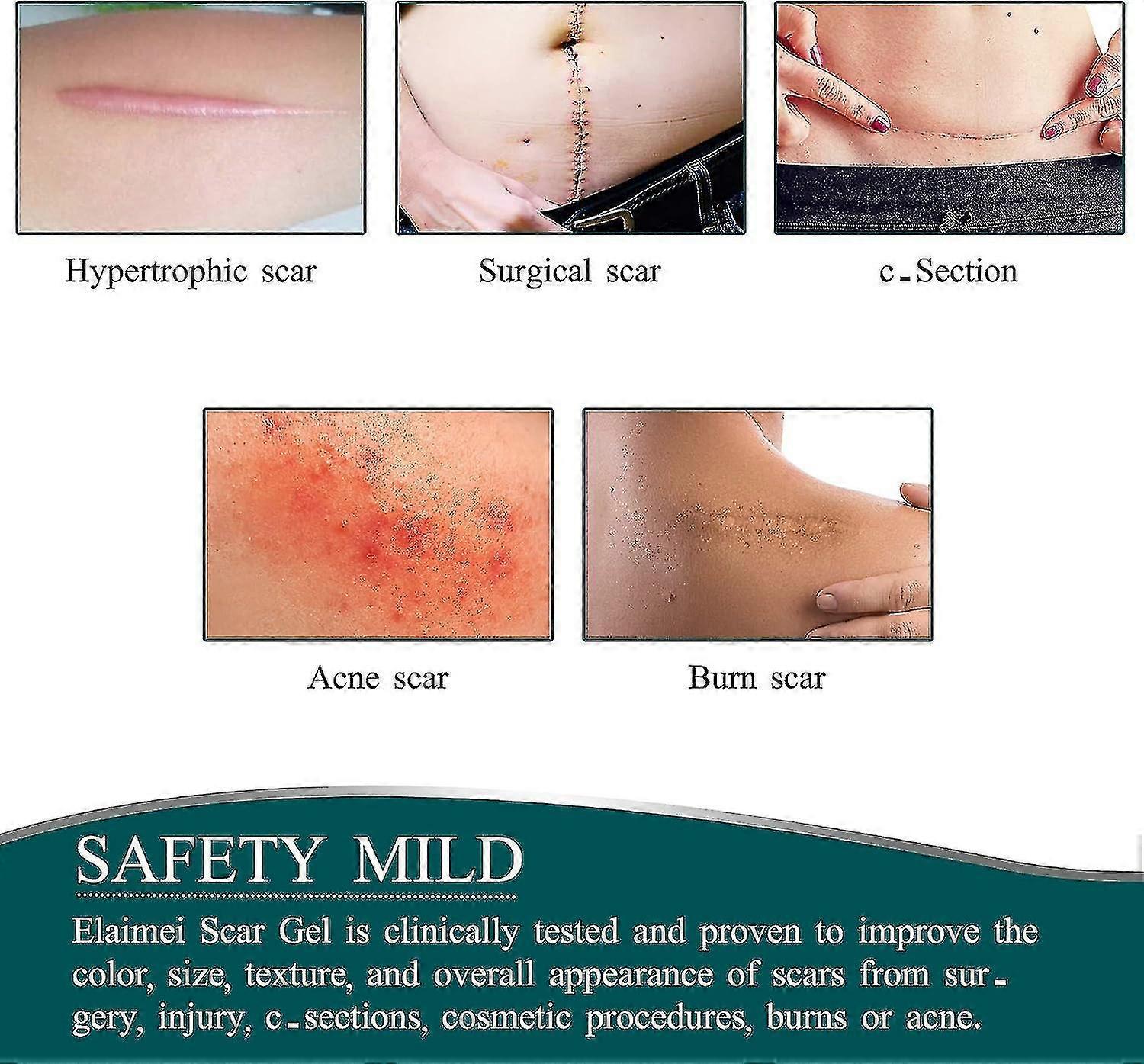 Advanced Silicone Scar Dressing - Your Solution for Scar Removal ...