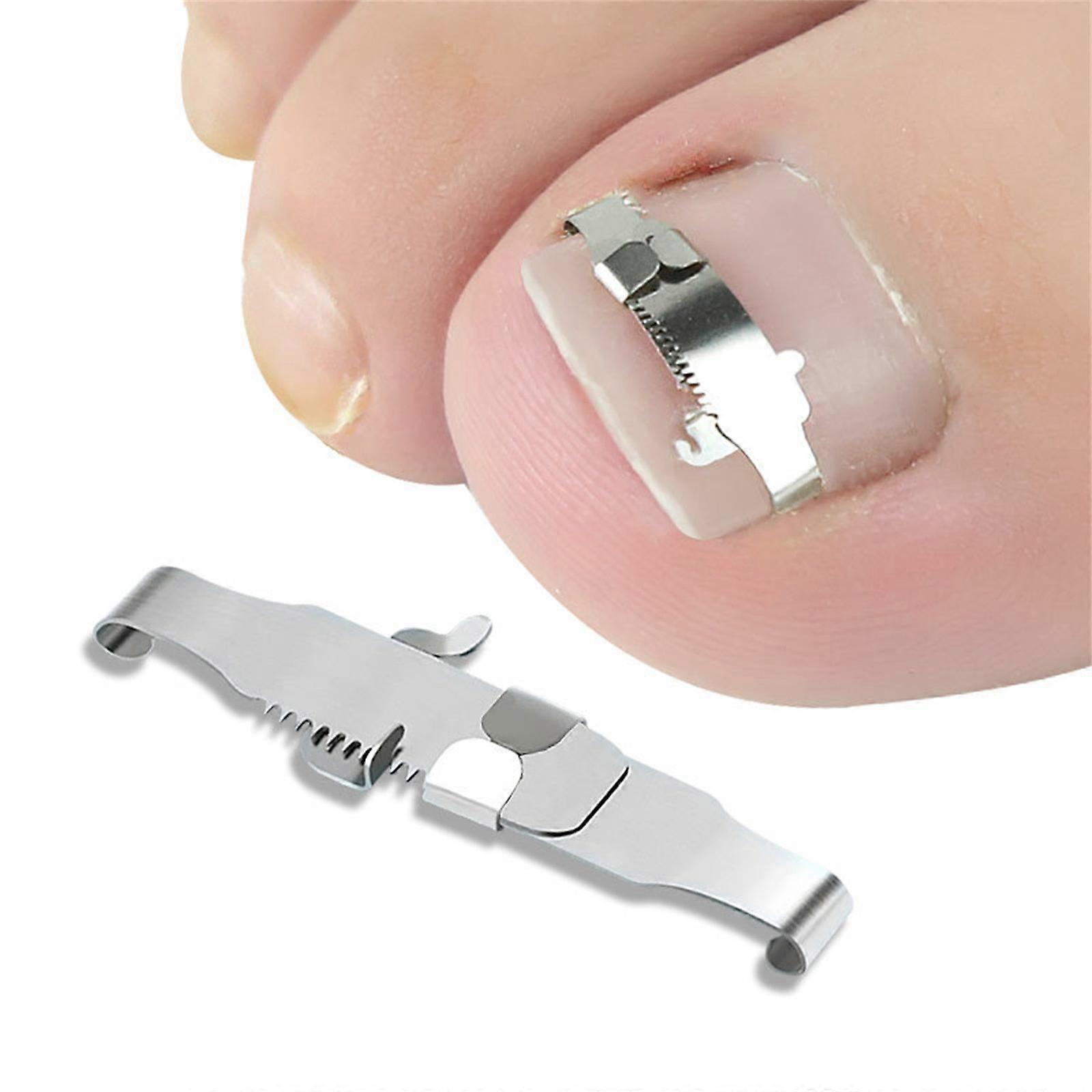 Orthopedic Buckle Nail Groove Ingrown Nail Orthosis Toenail Curling ...