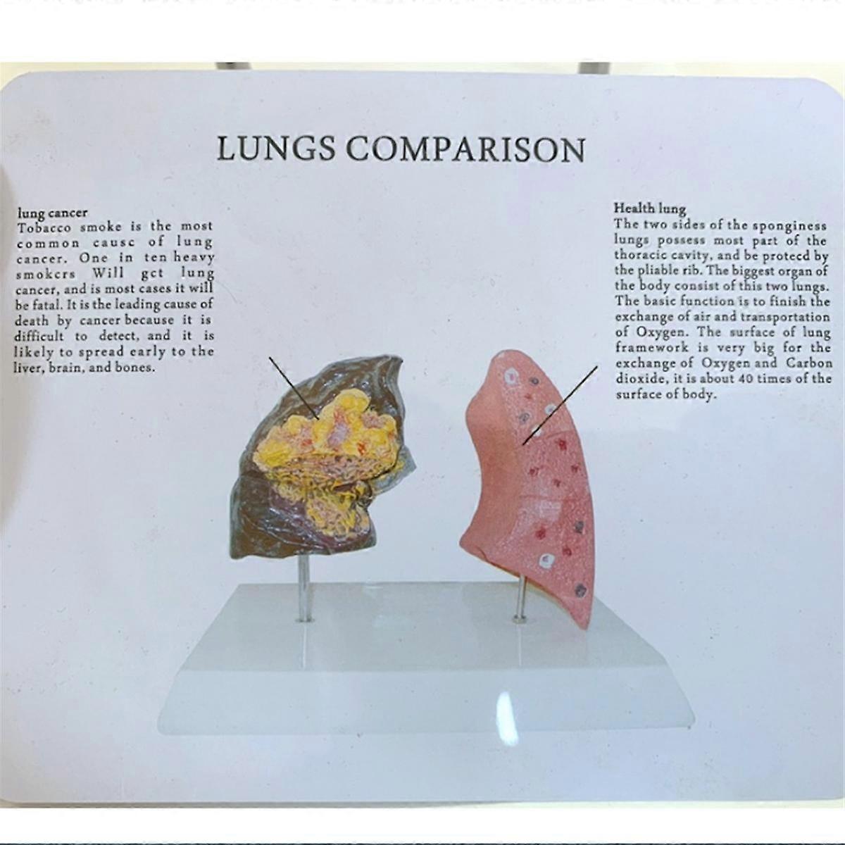 Smoker'S Lung Model Healthy Lung Model Lung Anatomy Model with ...