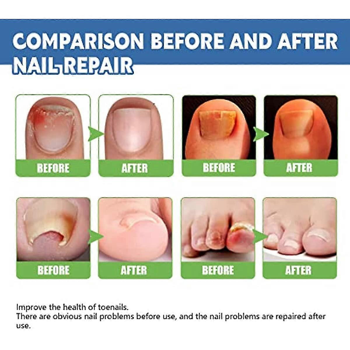 Nail Fungal Treatment Cream 30g Strong Anti-fungal Nail Treatment For ...