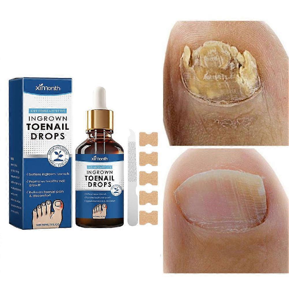 Ingrown Toenail Treatment. Ingrown Nail Repair Serum | Fruugo UK