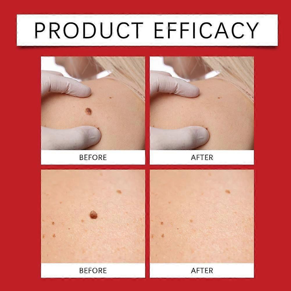 Microneedles Botanical Skin Appendage Removal Patch, Skin Patch for ...