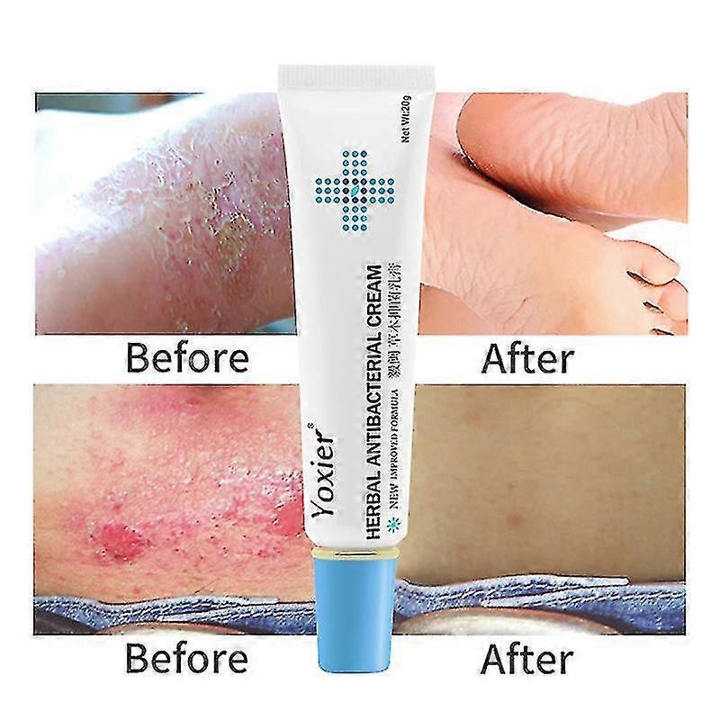 20g Skin Rash Cream Eczema Ointment Anti-Fungal Cream Psoriasis Treatm ...