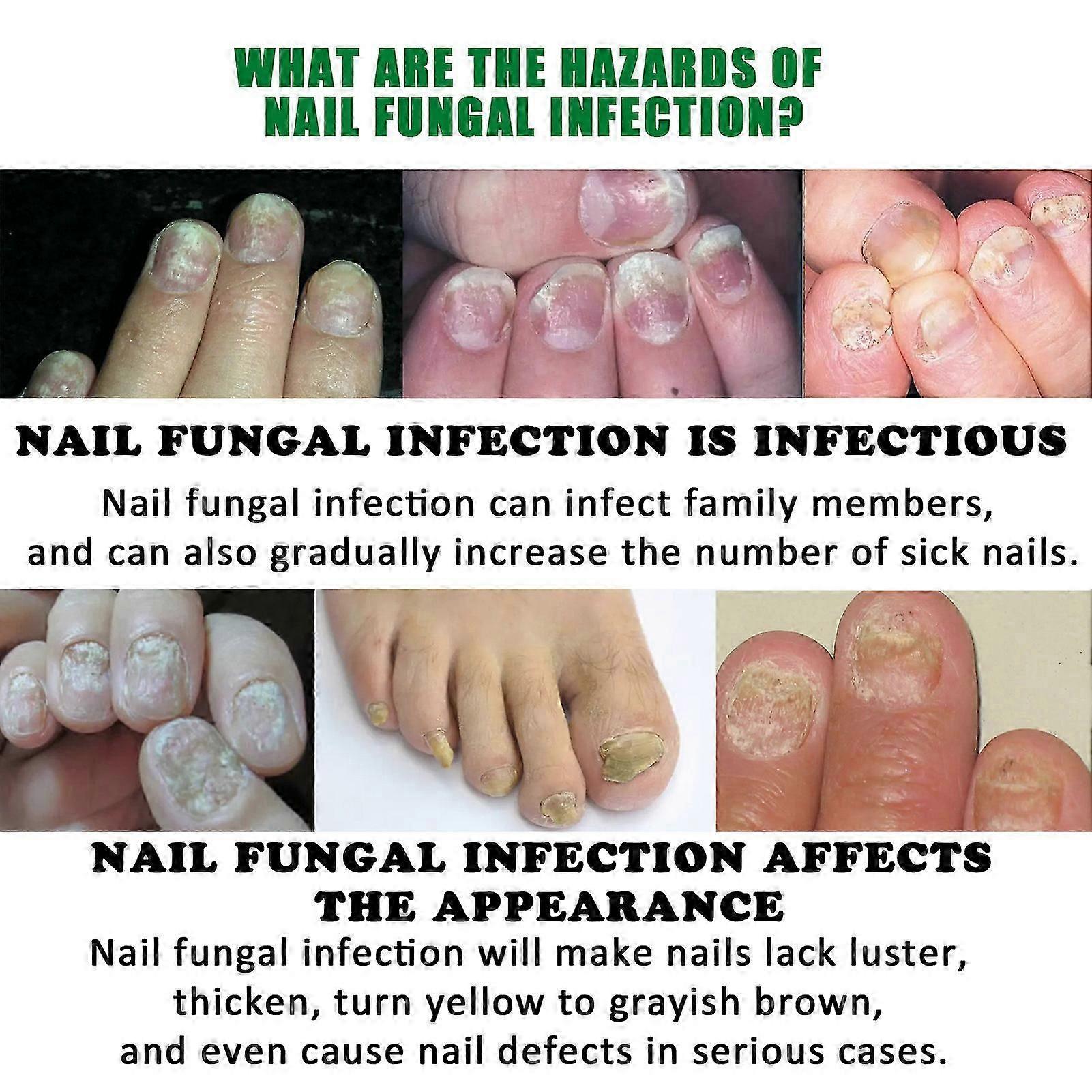 7days Nail Treatment, Ginger Nail Treatment, Multi-purpose Nail Repair ...