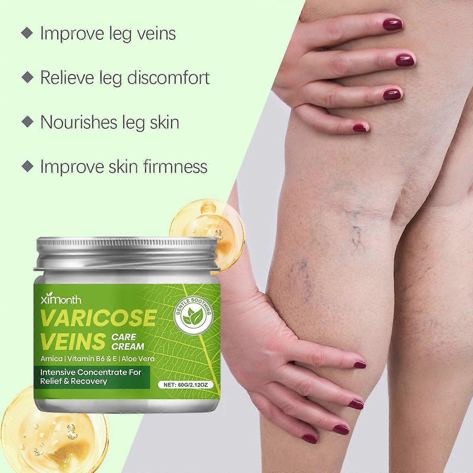 Varicose Relief Cream, Anti-Varicose Cream, Varicose Veins Treatment ...
