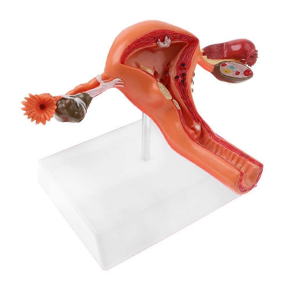 Medical props model Free postage Pathological Uterus Ovary Anatomical ...