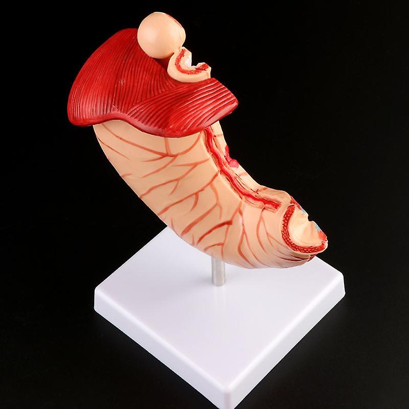 Human Anatomical Anatomy Stomach Model Gastric Pathology Gastritis ...
