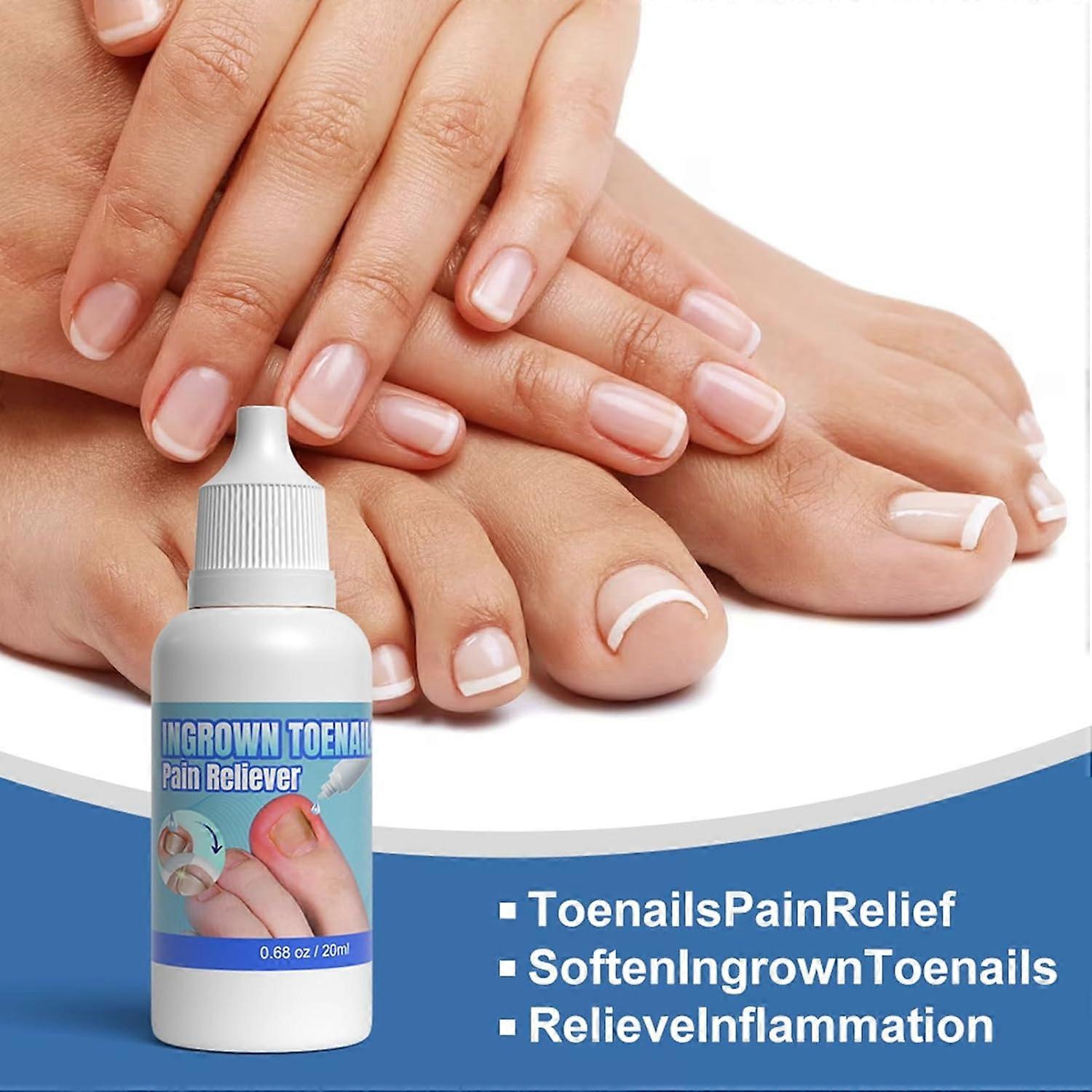 Ingrown Toenail Treatment Extra Strong,Ingrown Toenail Drop,Cuticle ...