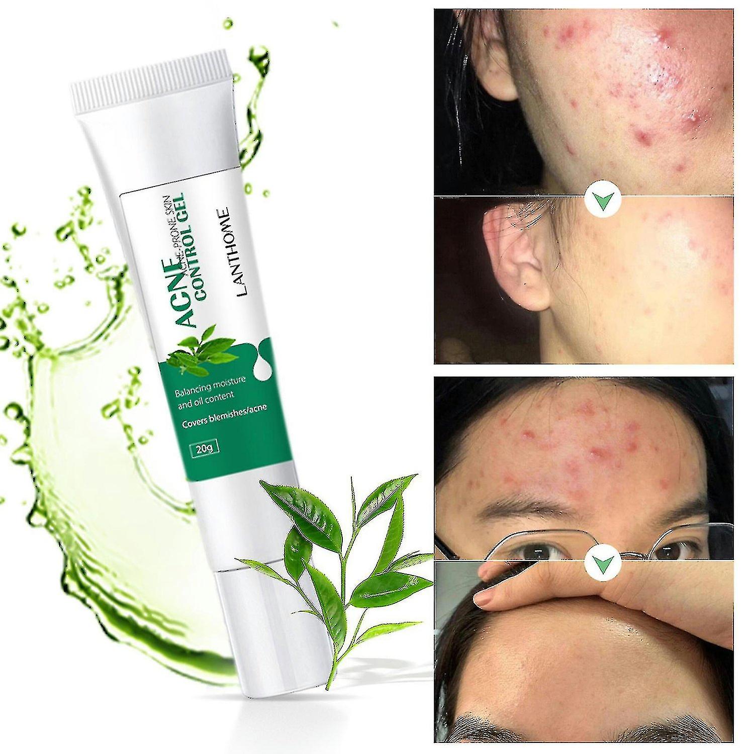 Tea Tree Gel Gel Cream Eliminate Pimple Pores For Face For Women Men ...