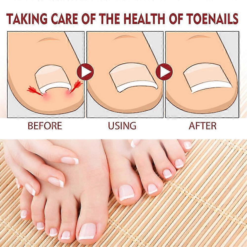 3x Nail Helper Ingrowth Toenail Correction Treatment Oil, Paronychia ...