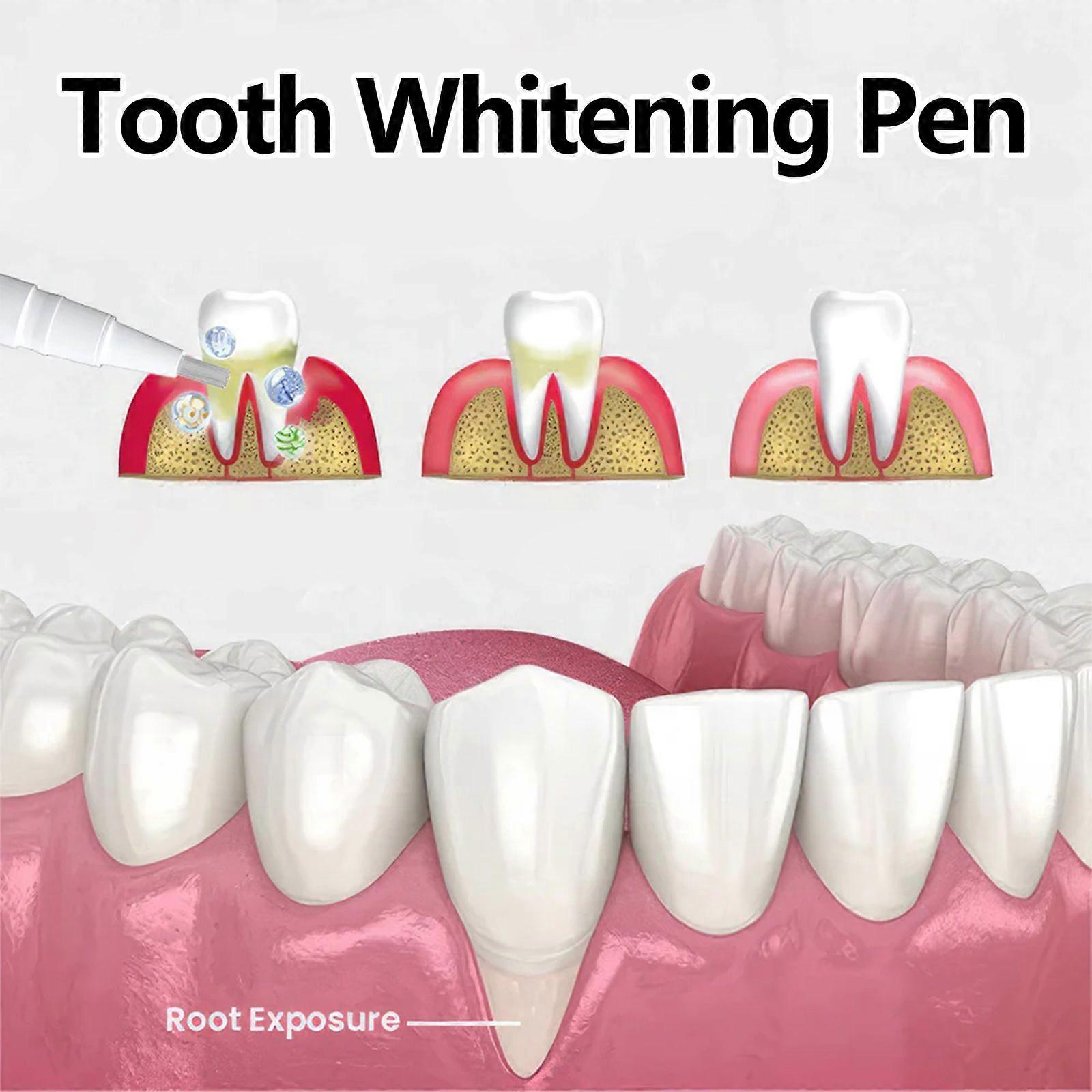 Tooth Whitening Pen, Oral Teeth Cleaning Dirt Yellow Teeth Smoke Teeth ...