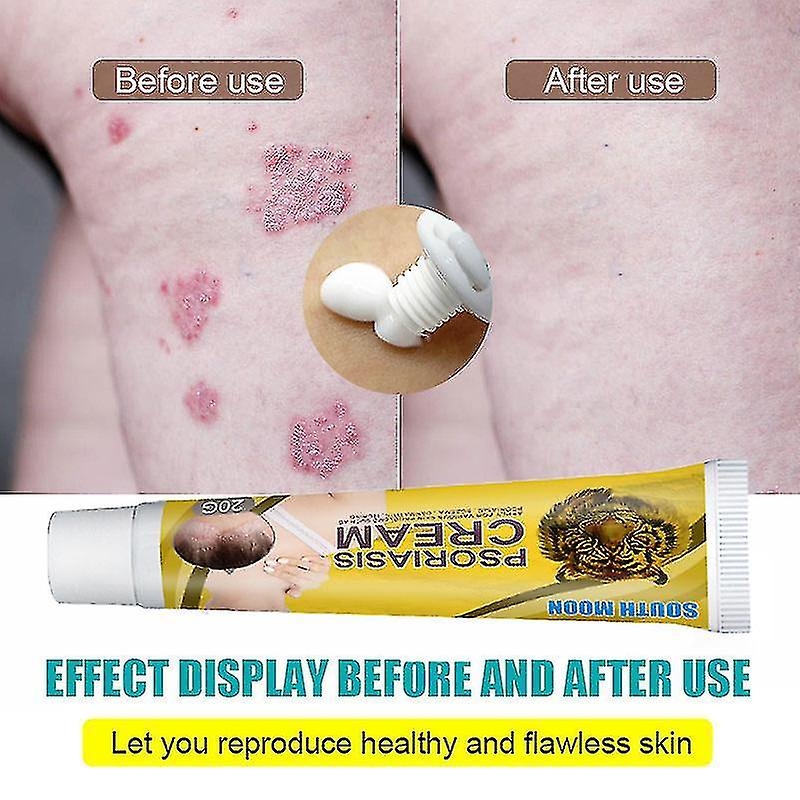 Huacreate Psoriasis Cream Eczema Ointment Scalp Psoriasis Hand Tinea ...