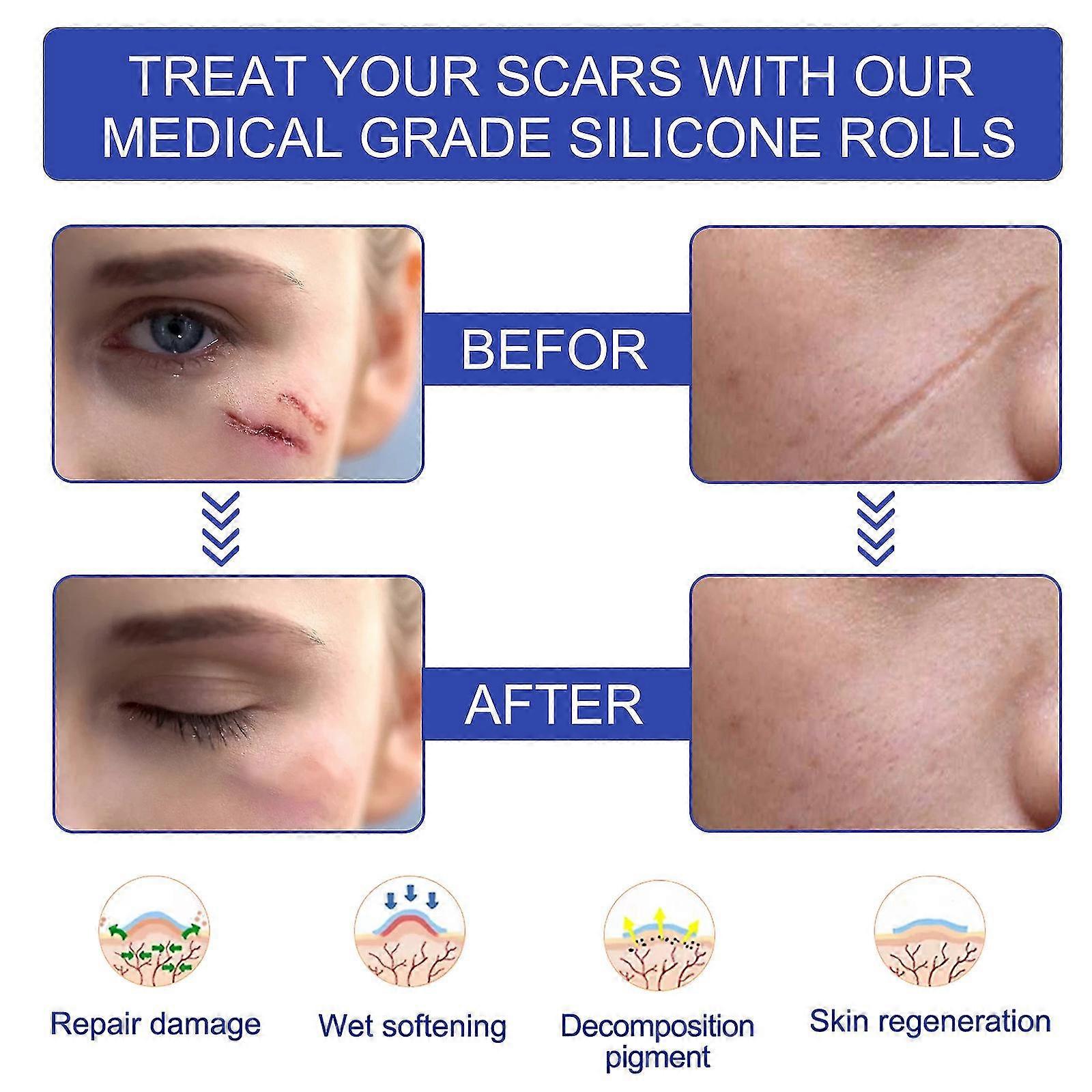 Silicone Scar Sheets, Clear Scar Tape, Silicone Scar Strips, Effective ...