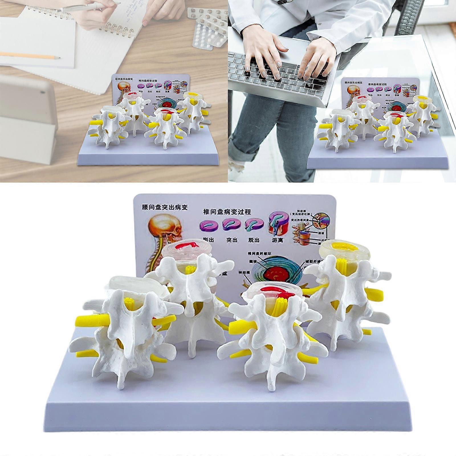 Human Skeleton Model for Anatomy Lumbar Spine 4 Stages Lesions ...