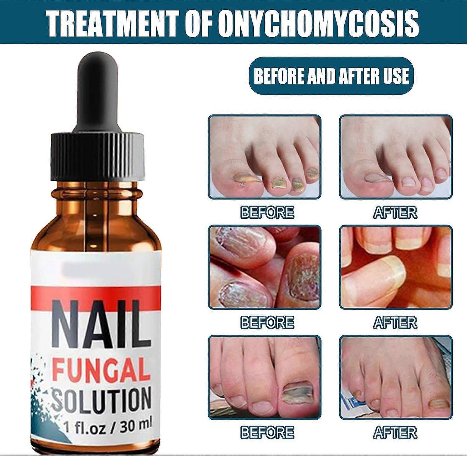 Nail Fungal Solution, Fungal Nail Treatment for Toenails Extra Strong ...