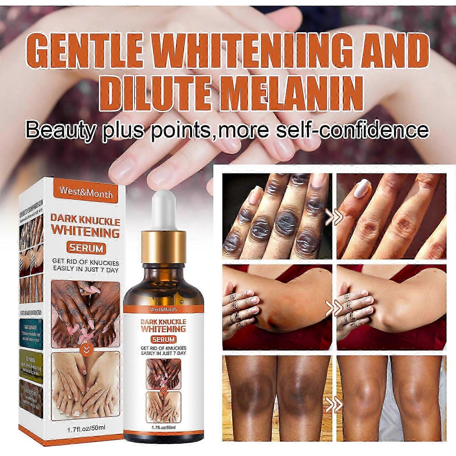 GFOUK Acanthosis Nigricans Therapy Oil, Dark Knuckles Serum 50ml - 1/3 ...