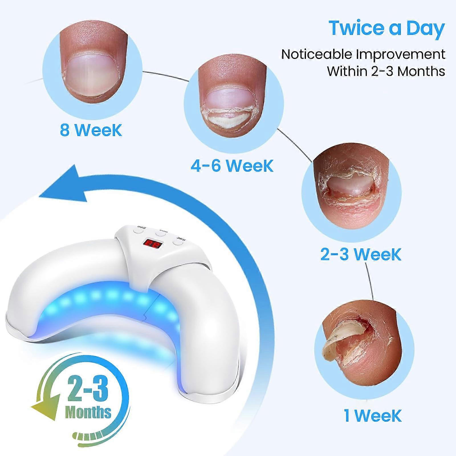 Nail Fungal Laser Device, Nail Fungus Treatment for Toenai, Laser ...