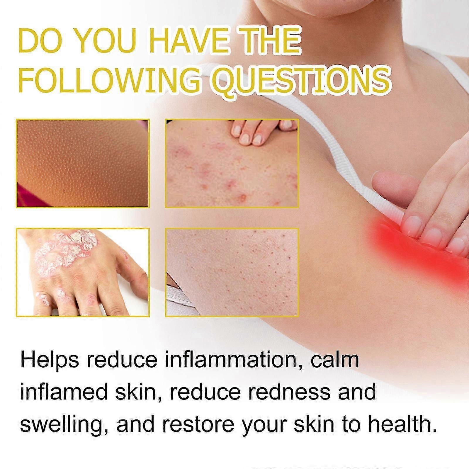 Skin care cream, psoriasis care cream, relieve the body skin itching ...