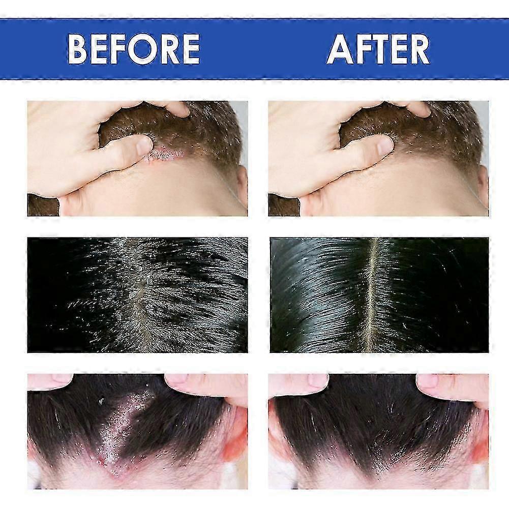 Seborrheic Skin Cream Head Acne Tinea Pruritus Anti-itch Psoriasis ...
