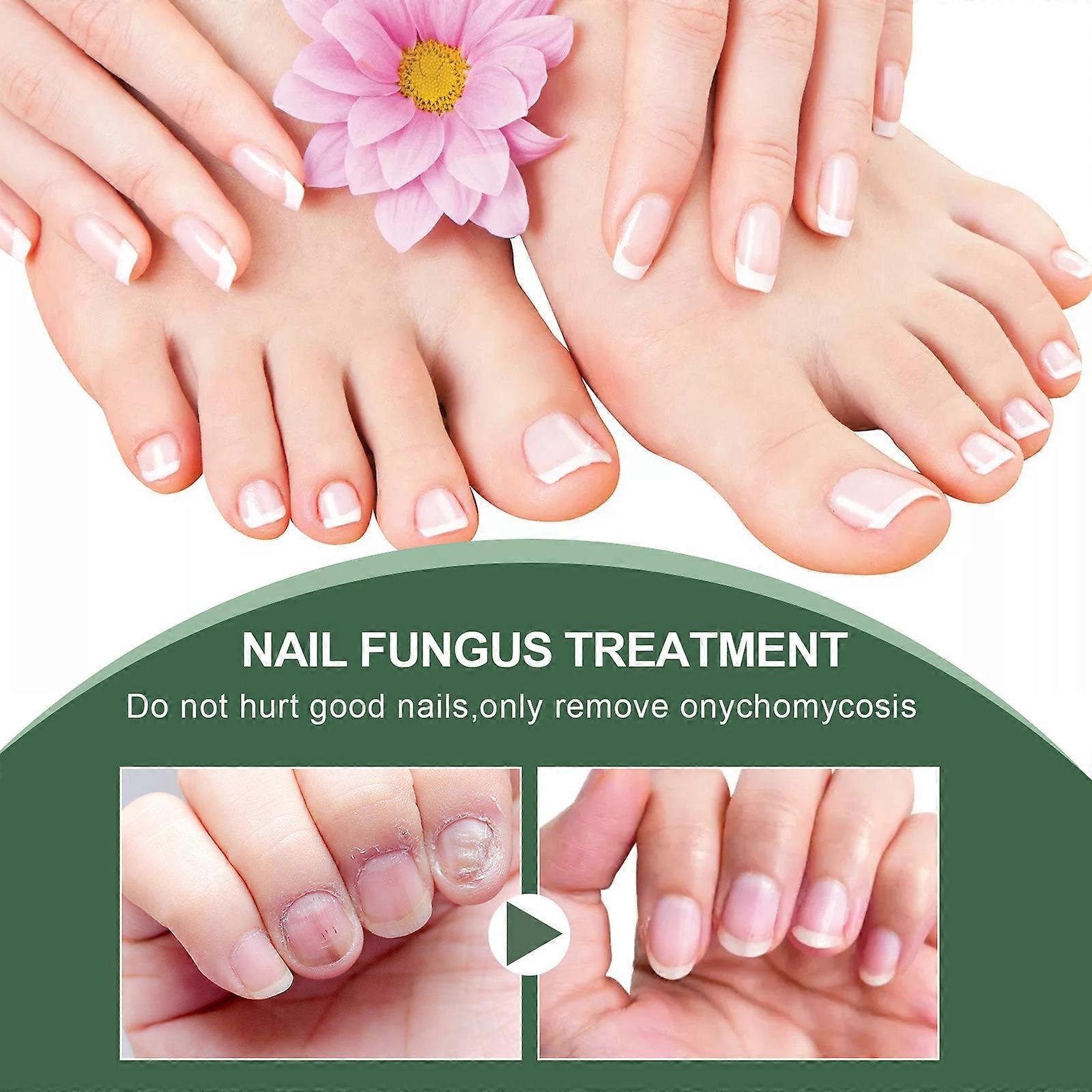 2set Extra Strong Finger & Toenail Fungus Treatment - Best Nail Repair Set, Fungi Fingernail ...
