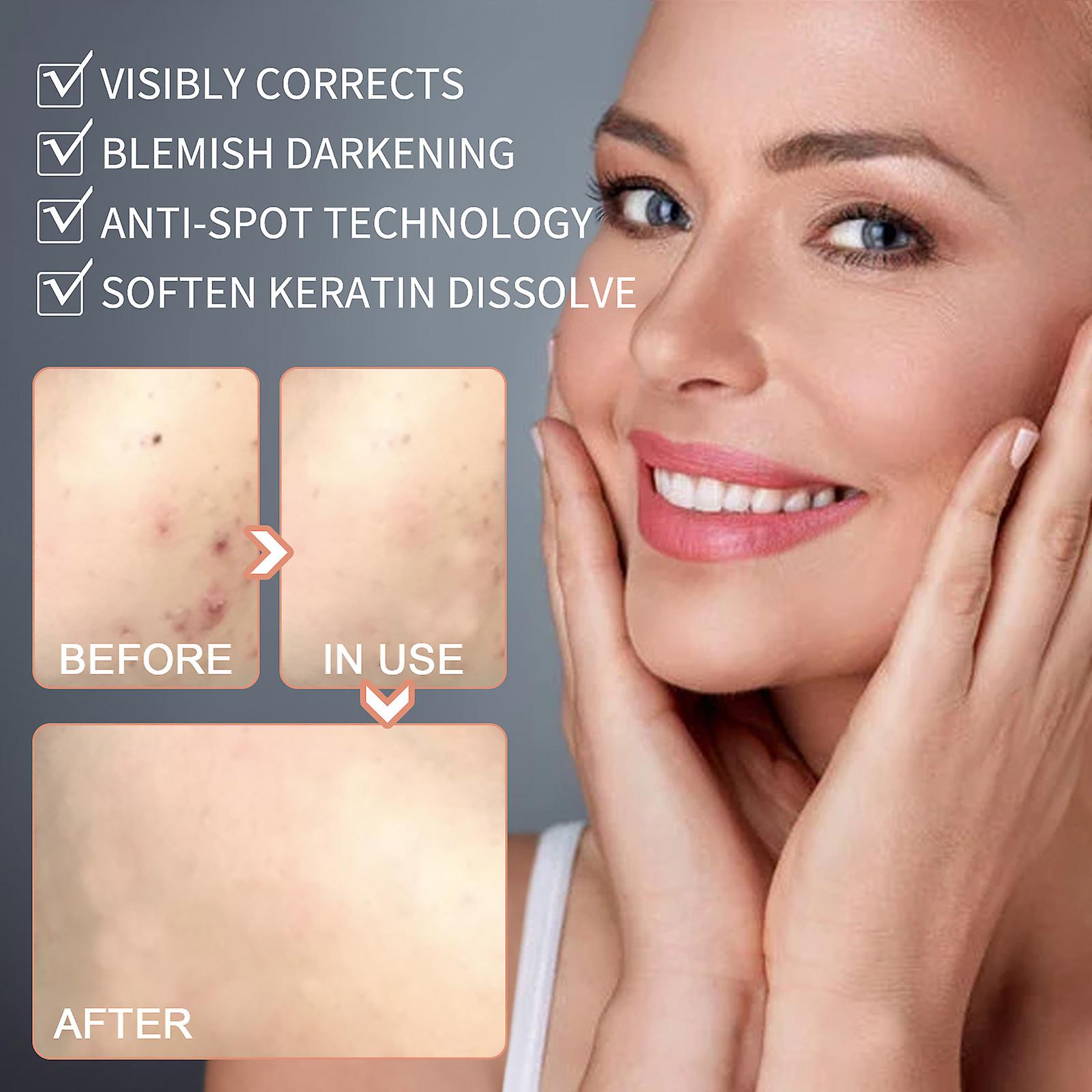 Qian Eelhoe Peau Nettoyage Gram Verrue Keyou Liquide Corps Visage ...