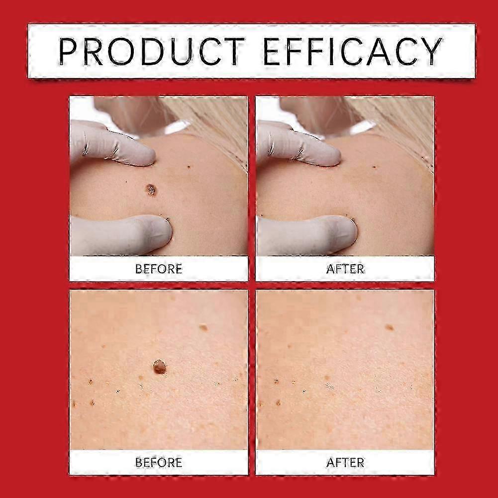 Microneedles Botanical Skin Appendage Removal Patch, 2025 Skin Patch ...