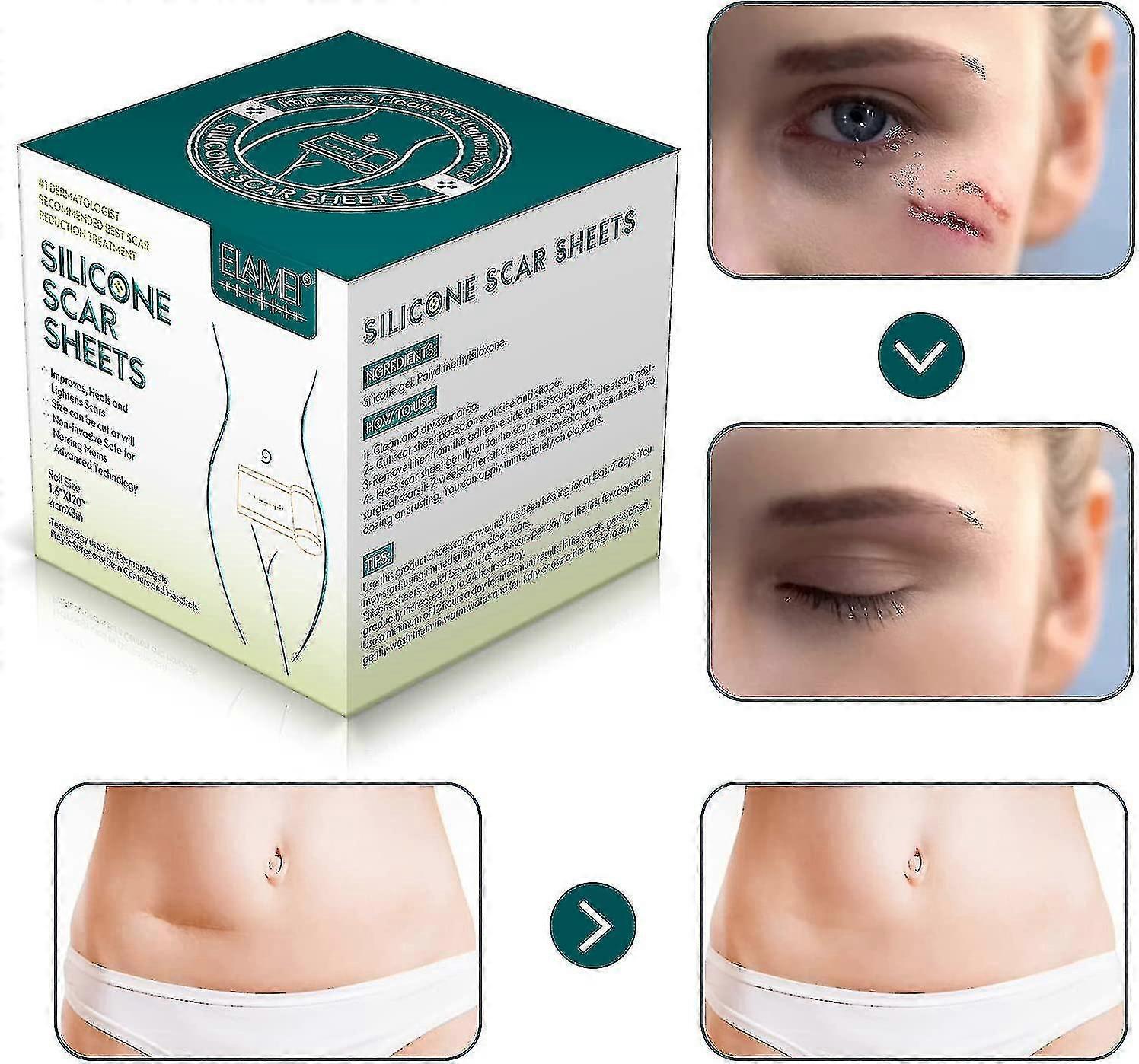 Silicone Plasters For Scars, Silicone Scar Films For Surgeries ...