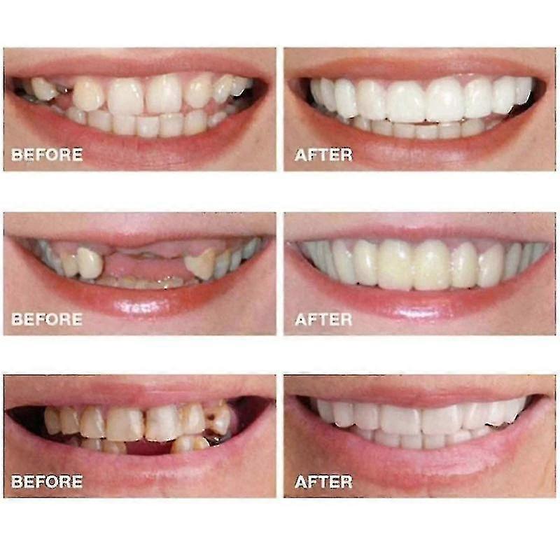 Fake Teeth Cosmetic Denture Veneers for Upper and Lower Jaw Dental ...
