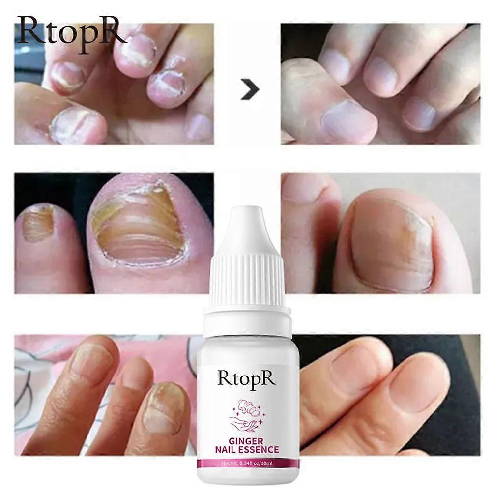 RtopR Ginger nail polish Nail Treatment Fungal Nail Repair Rough nail ...