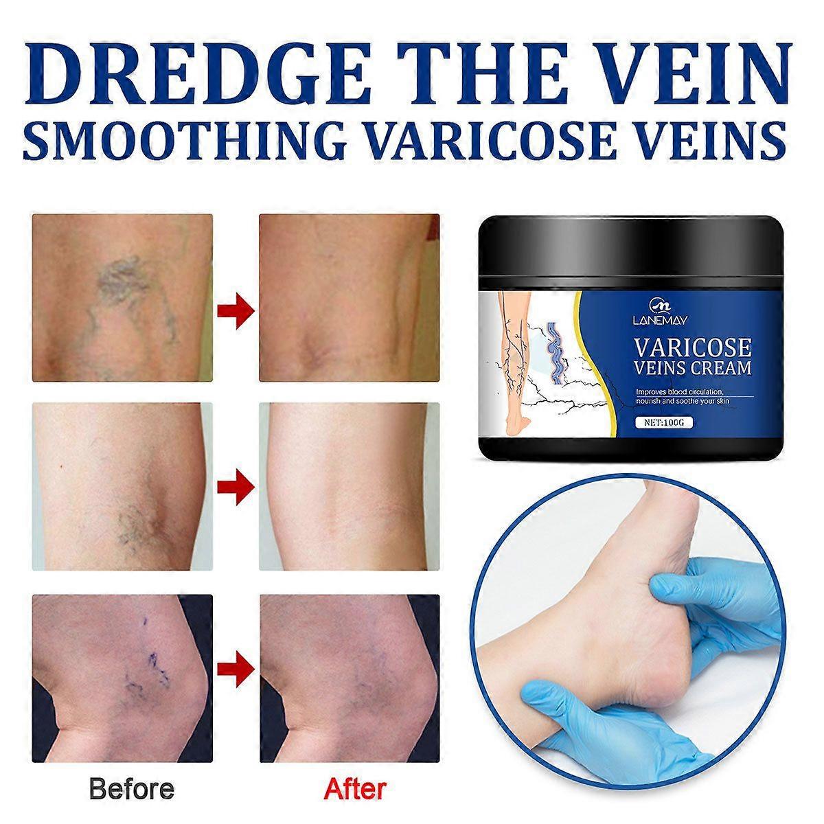 Varicose Vein Cream 50g Varicose Vein Cream Anti-spider And Vein ...