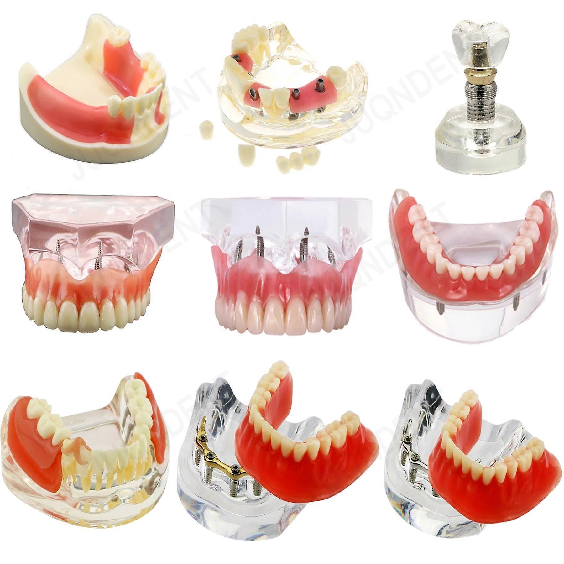 Dental Model Dental Teaching Model Overdenture Implant Models For ...
