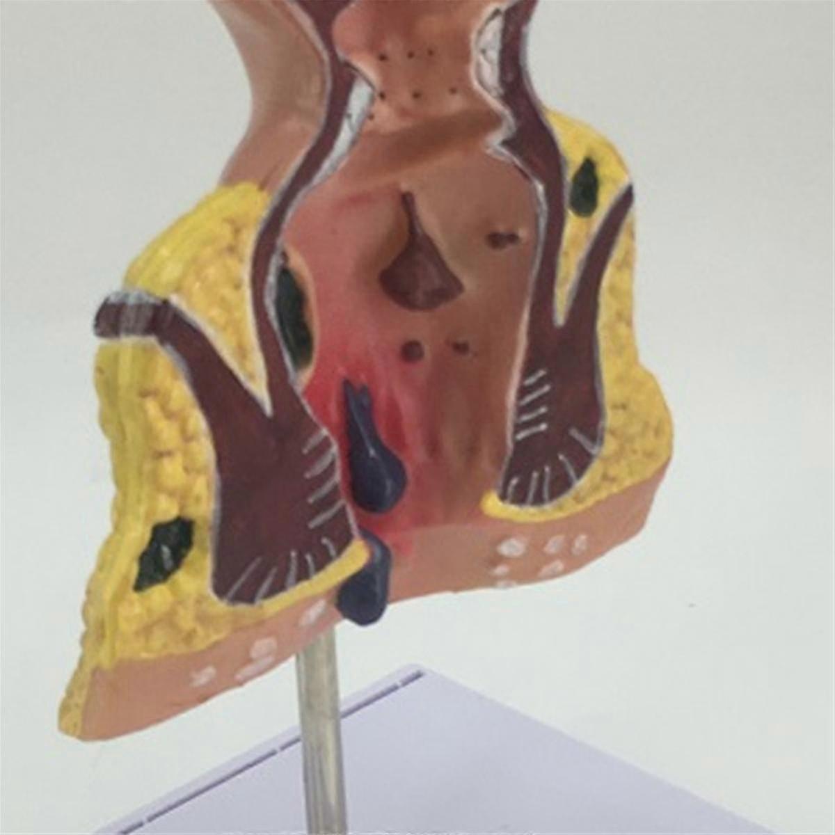 Human Rectum Model With Common Pathologies,replica For Anatomy And Physiology Education,doctor's ...