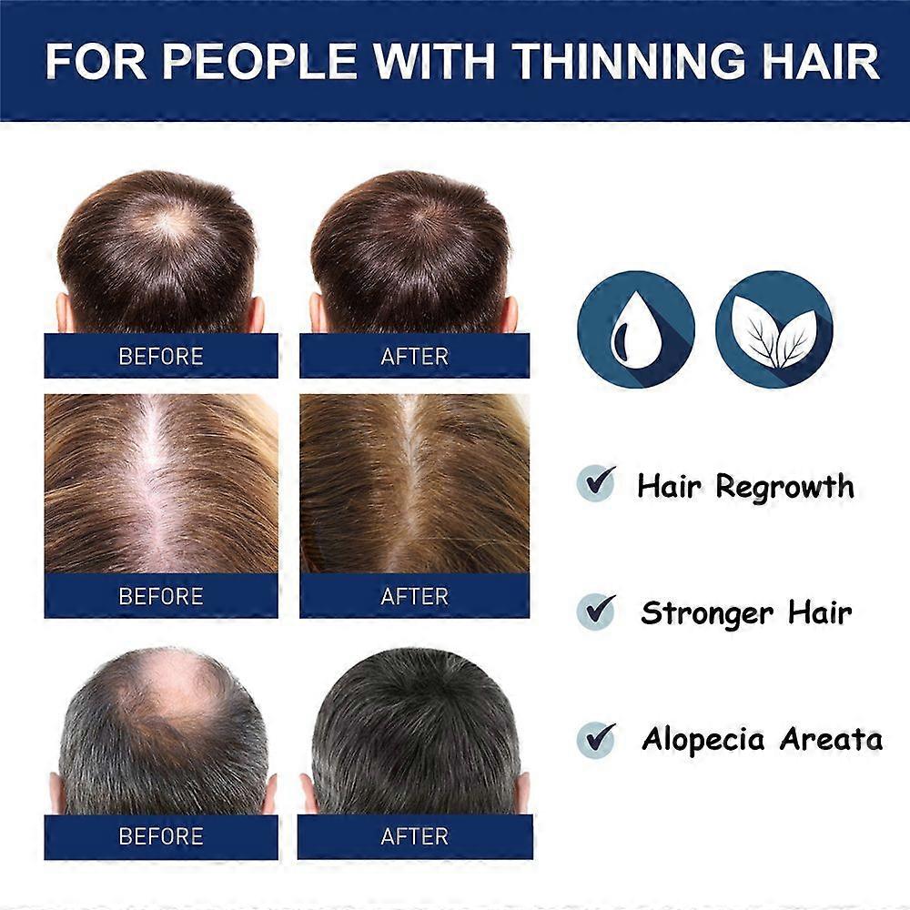 Alopecia Treatment Cream Hair Growing Prevent Alopecia Baldness Regrowth Ointment Hairs Root ...