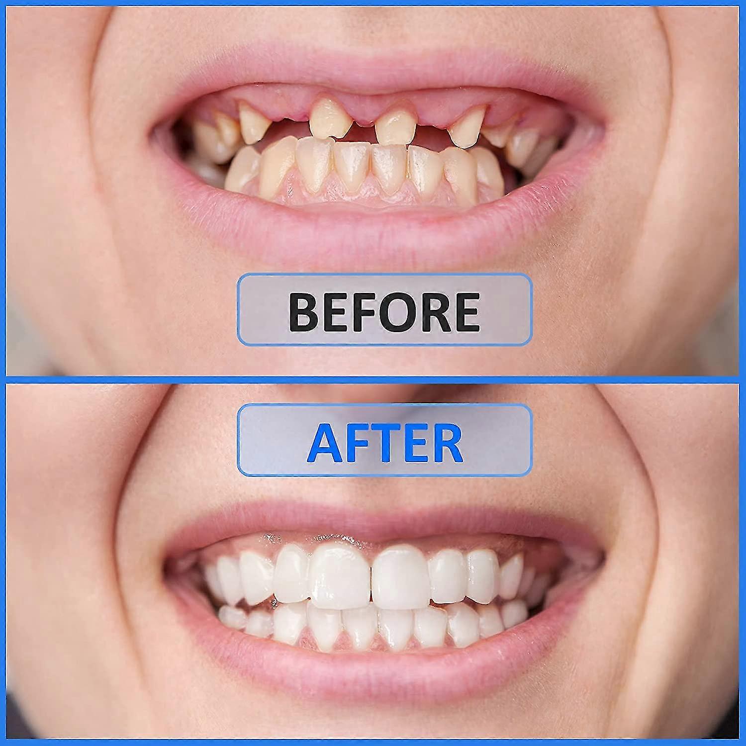 50 Piece Temporary Crown Restoration Kit Veneer Mixture For Posterior ...