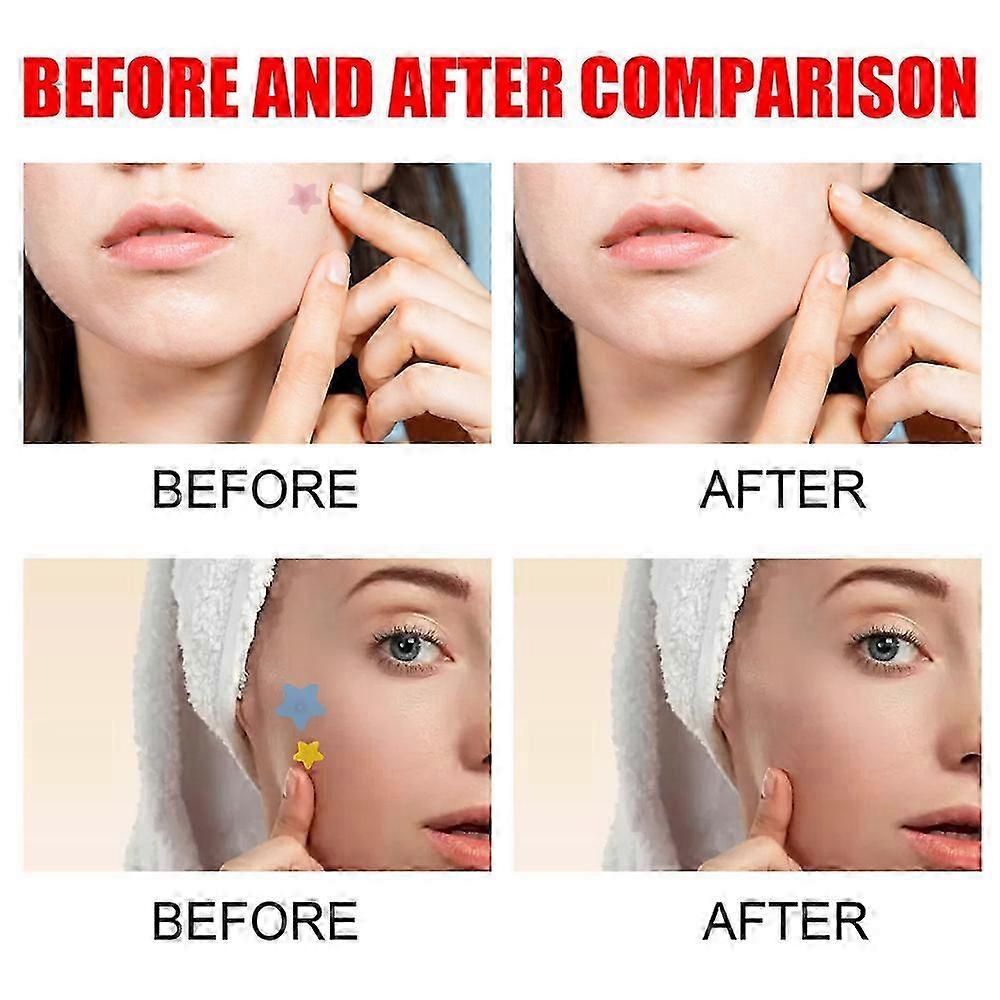 600pcs Pimple Patches For Face Hydrocolloid Acne Patches Versitile Cute ...