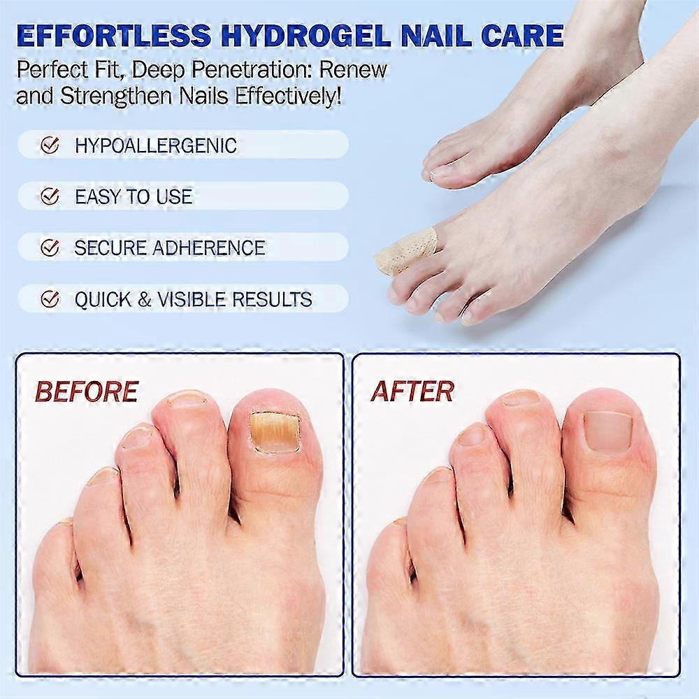 oenail Fungus Patch Waterproof Nail Repair Patches Nail Ingrown ...
