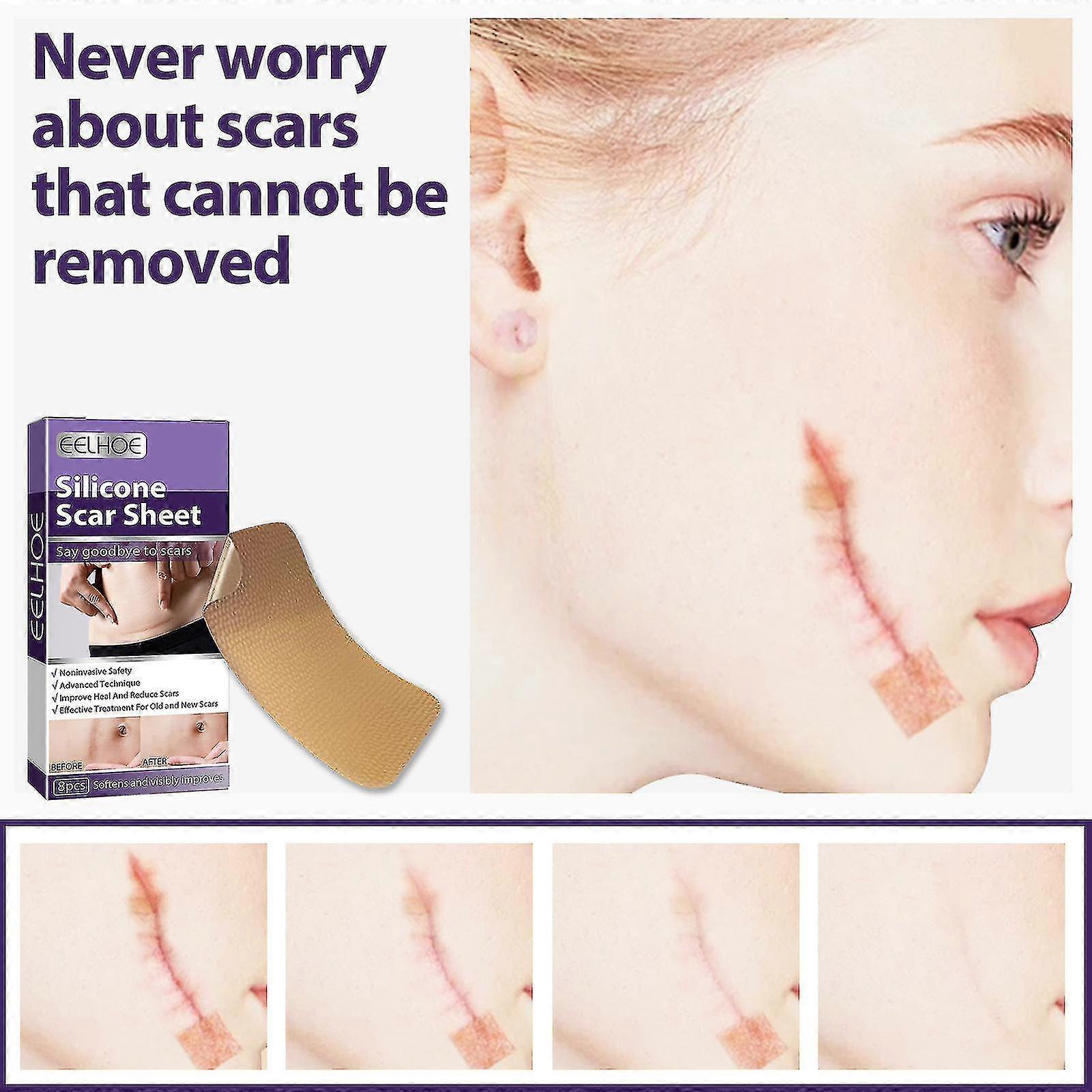 Silicone Scar Sheets, Silicone Scar Strips, Effective Scars Away ...