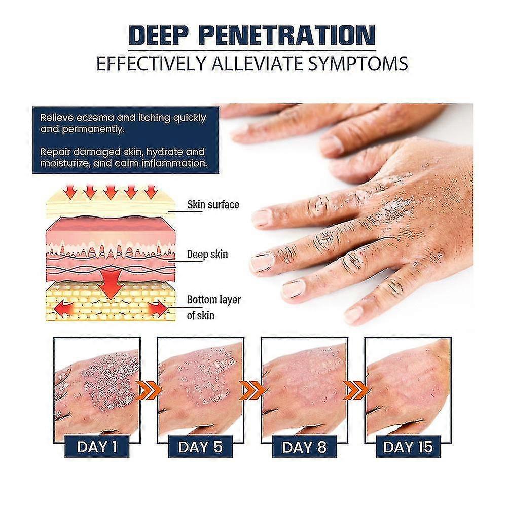 Psoriasis Treatment Spray Hand Foot Scalp Anti-itch Desquamation Tinea ...