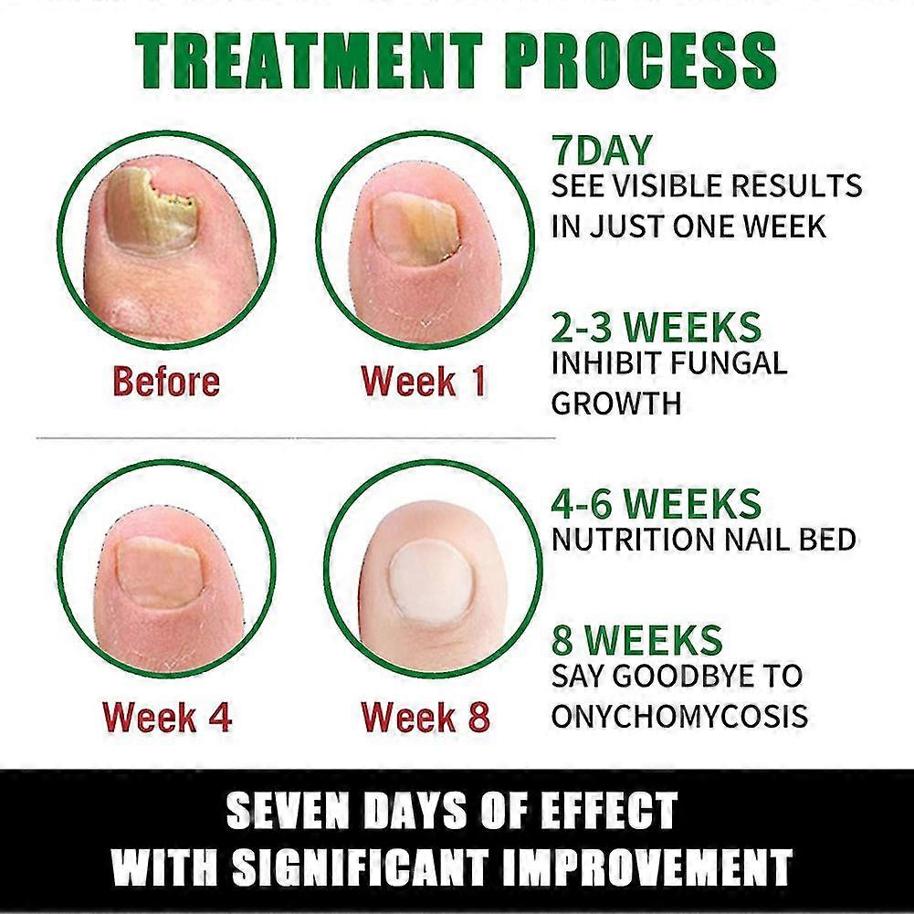 Nagelschimmel Behandelingen Serum Voetverzorging Serum Teen Nagels ...