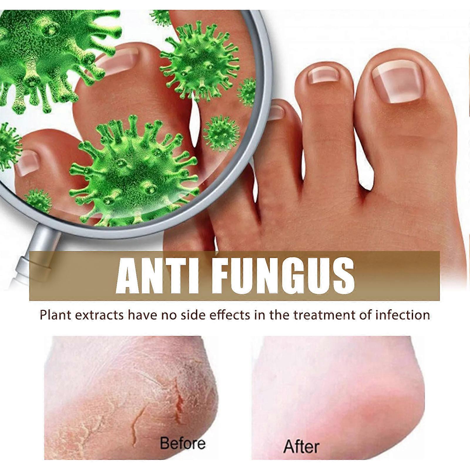 30ml Herbal Fungal Combat Feet Spray Anti Fungal Infections Prevent ...