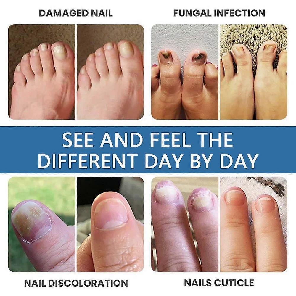 Extra Strong Fungal Nail Treatment - Effective Solution For Finger & Toenail Fungus, Protects ...