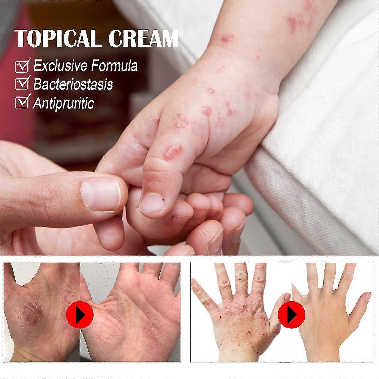 South Moon sweat blisters hand and foot anti-itch cream dry itchy skin ...