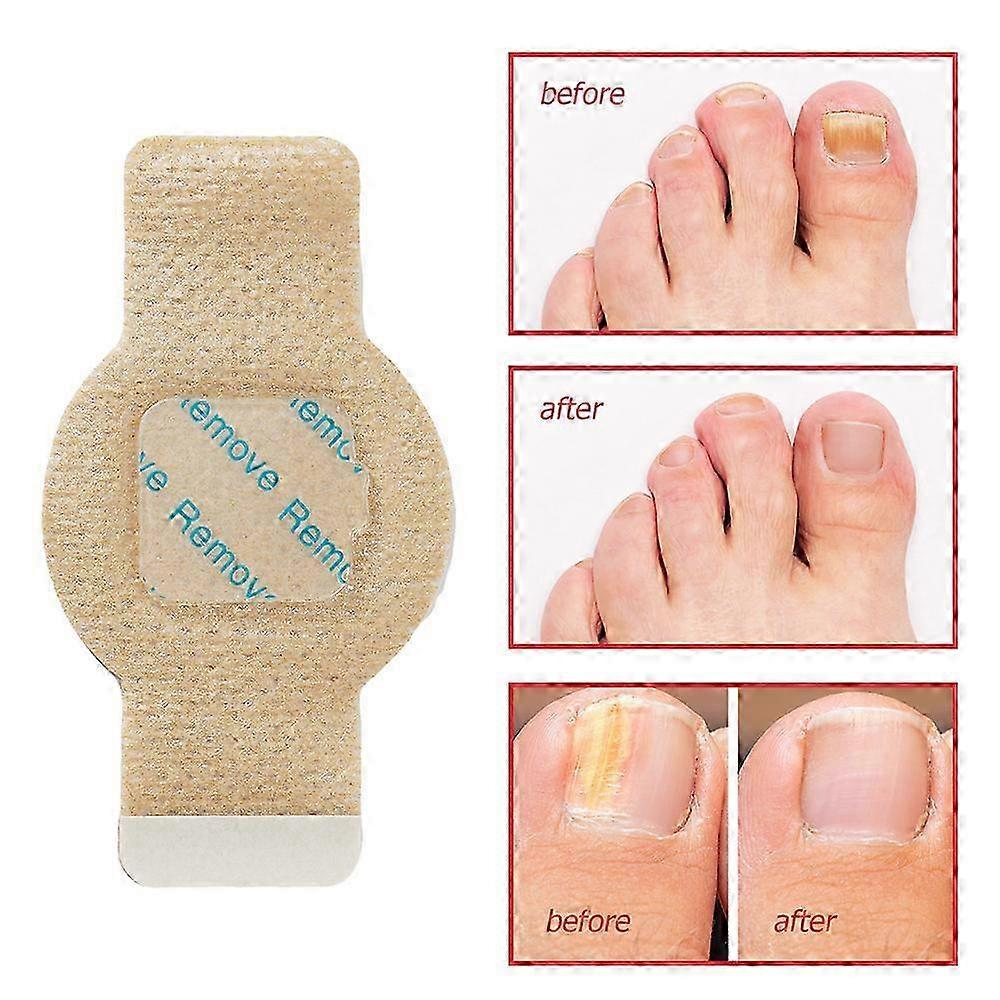 Toenail Fungus Patch Waterproof Nail Repair Patches Nail Ingrown Correction Stickers 1/2/3/4 ...
