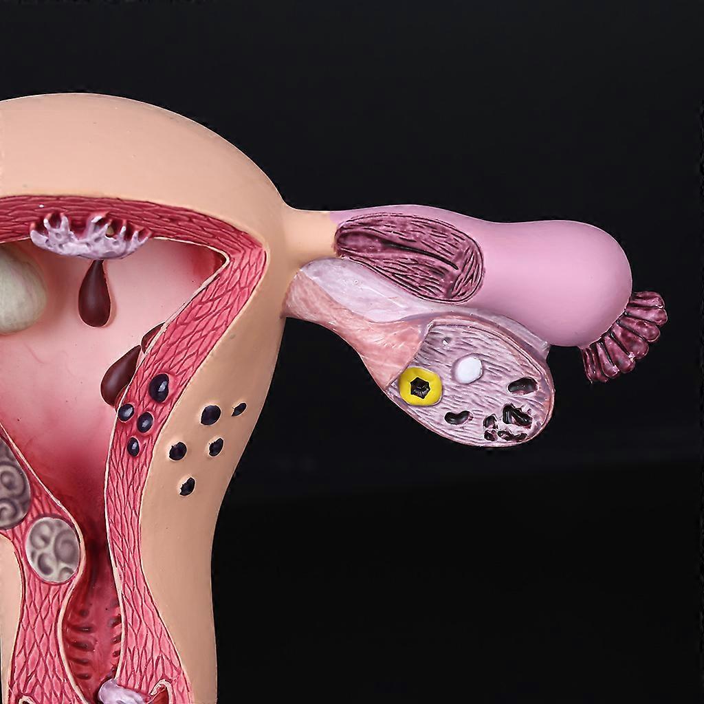 Human Female Uterus Ovary Disease Dissection Pathology Model Biology Teaching Aids Anatomy ...