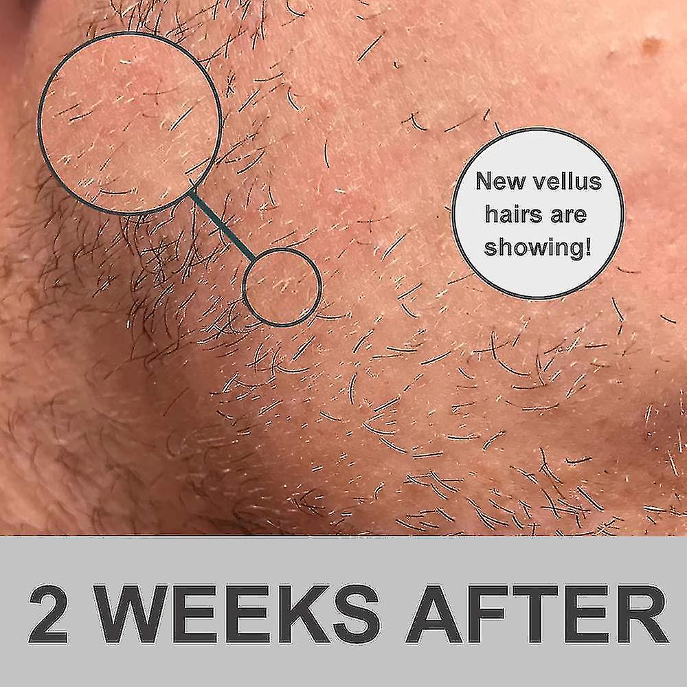 Beard Growth Kit, Beard Derma Roller 0.3mm, Beard Oil For Facial Hair ...