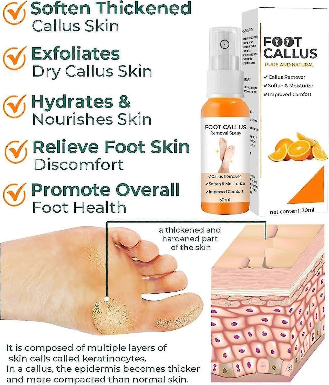 Foot Callus Removal Spray, Foot Heel Callus Remover Spray, Foot Peel ...