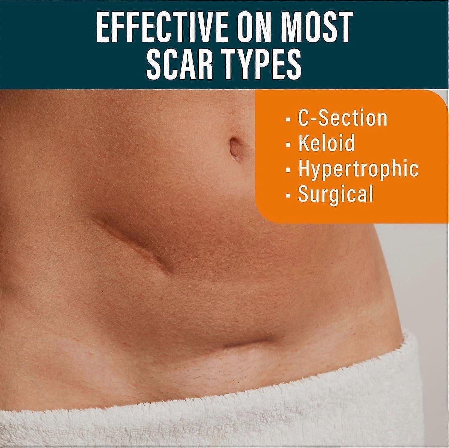 high quality Silicone Scar Sheets - Extra Long Scar Sheets for C ...